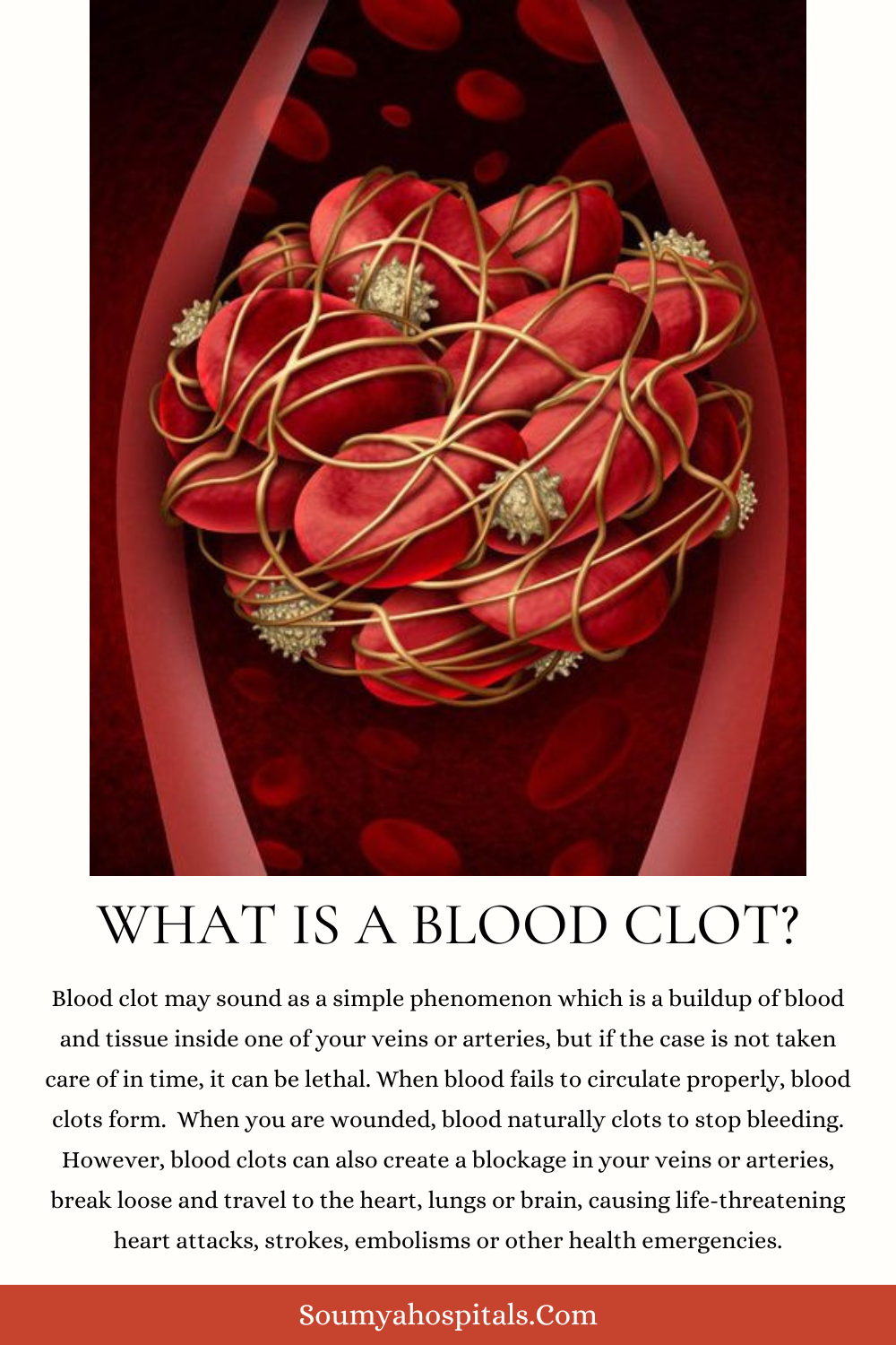 How to Prevent Blood Clots Naturally? - soumyahospitals.com
